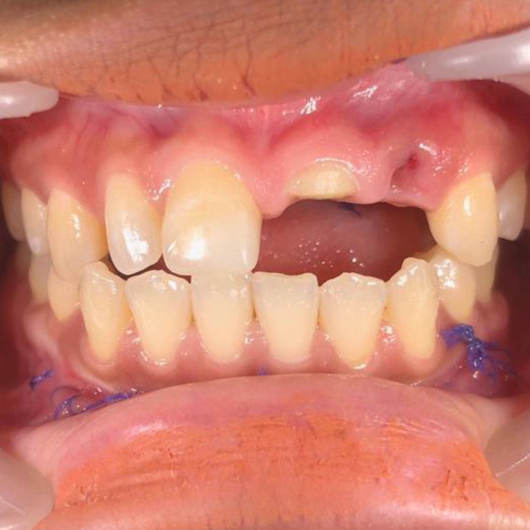 BEST BRACES RESULTS IN JB | ADDA DENTAL JOHOR BAHRU JB